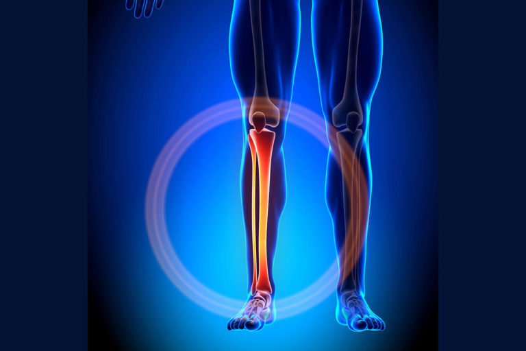 Tibia: Guida alle Lesioni e alla Guarigione - La Palestra
