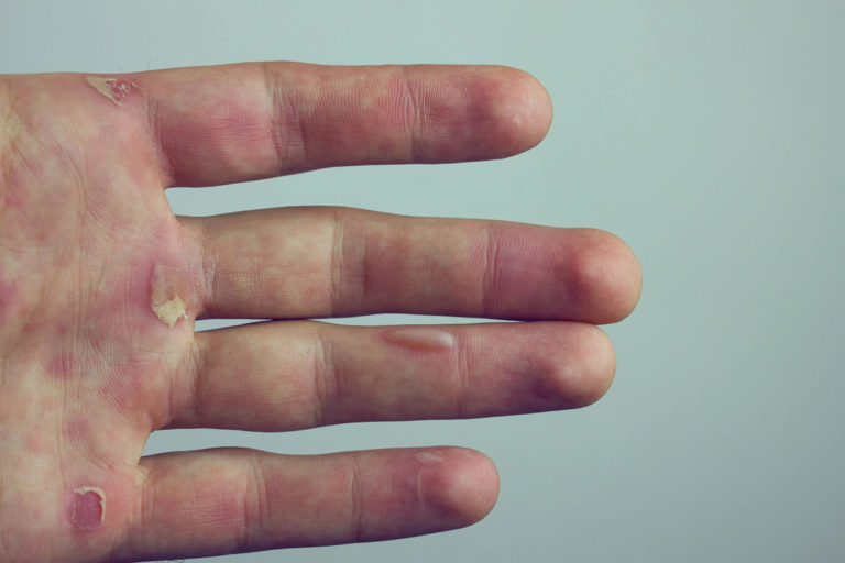 Come Togliere i Calli: guida completa - La Palestra